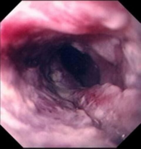 Cáncer de Esófago | Dr. Israel Hernández | Cirujano de Torax